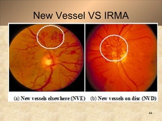 Diabetic Retinopathy: A complete update | PPT