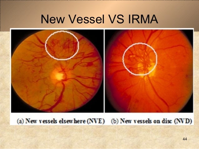 Diabetic Retinopathy: A complete update