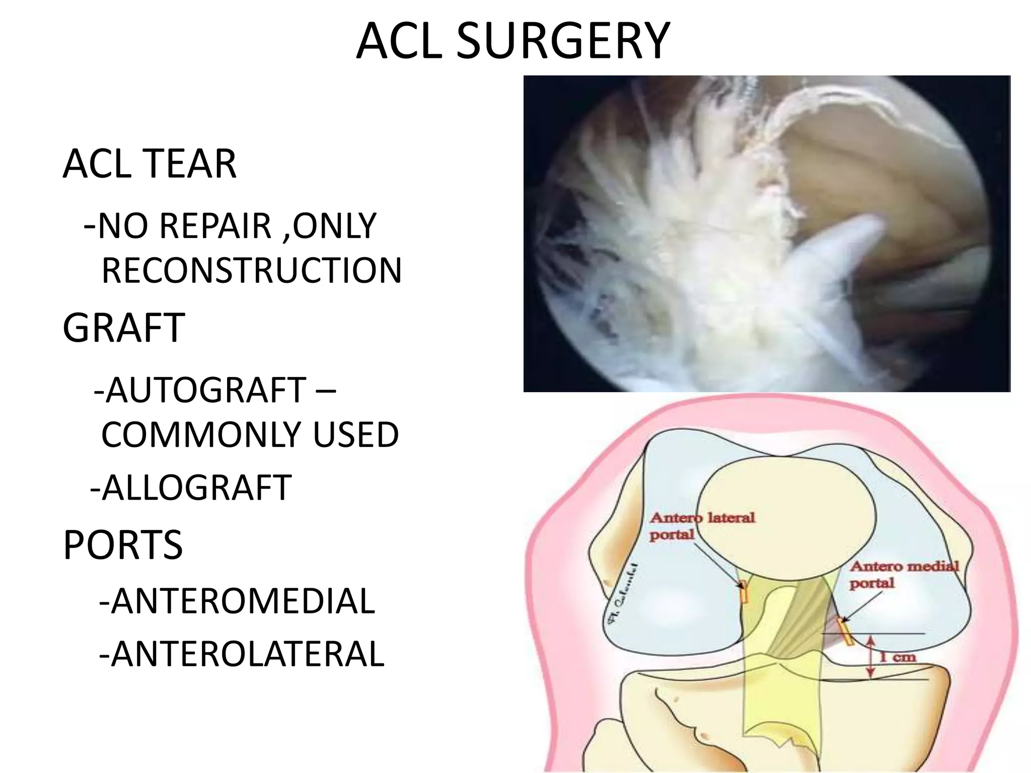 A TO Z OF ACL INJURIES | PPTX | Death, Injury, or Military Conflict ...