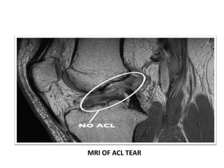 A TO Z OF ACL INJURIES | PPTX