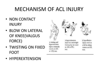 A TO Z OF ACL INJURIES | PPT