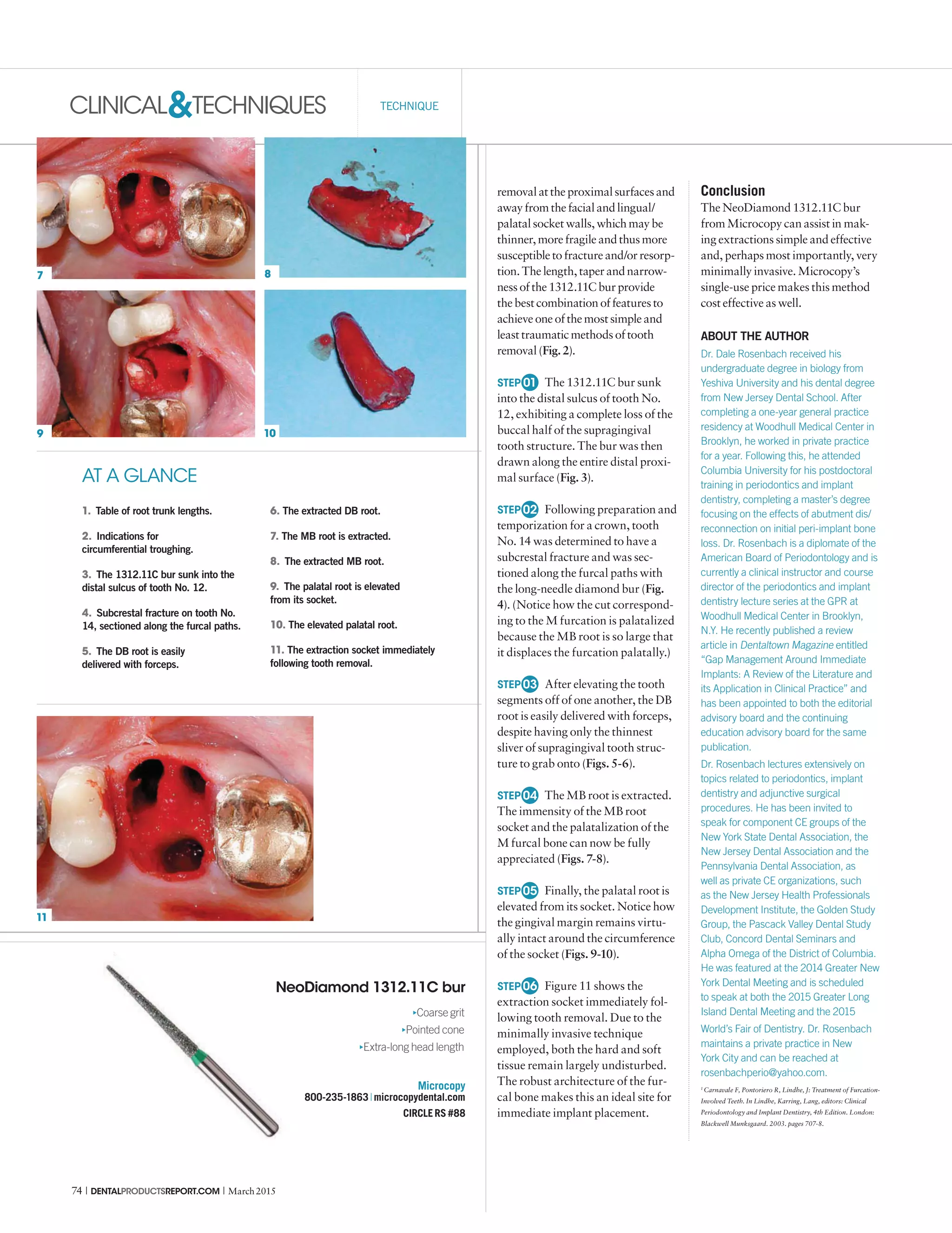 How to Extract a Tooth as Atraumatically as Possible (Rosenbach 2015) | PDF
