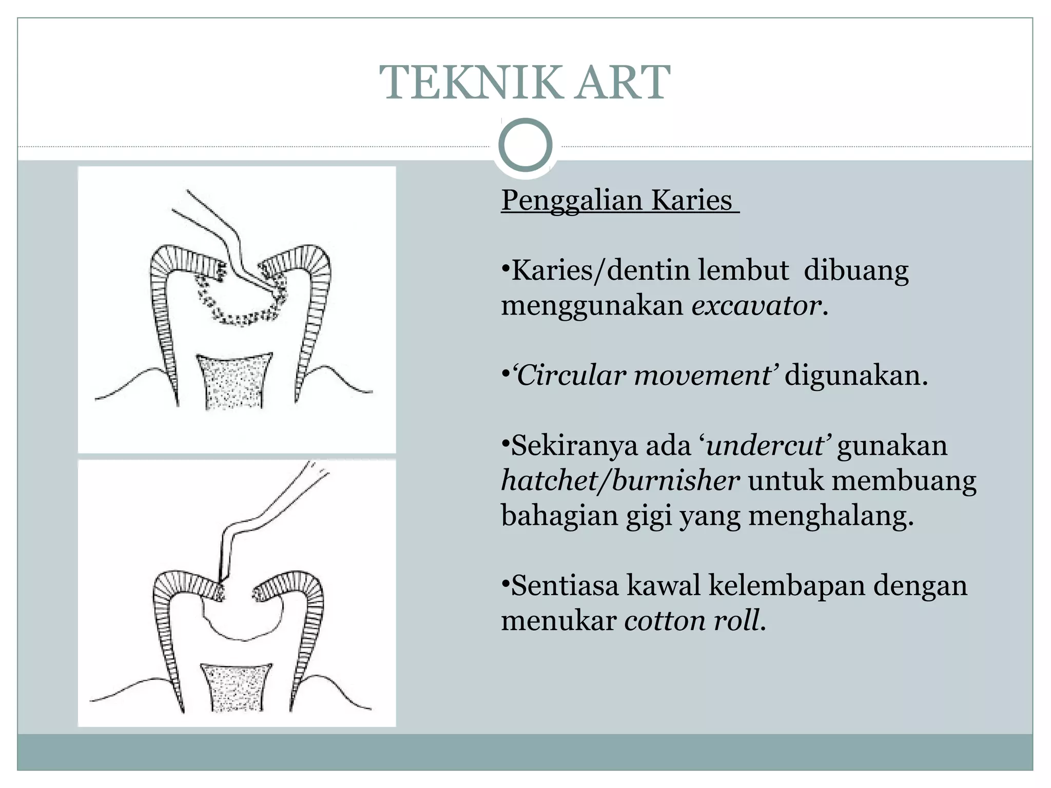 Atraumatic restorative technique | POT