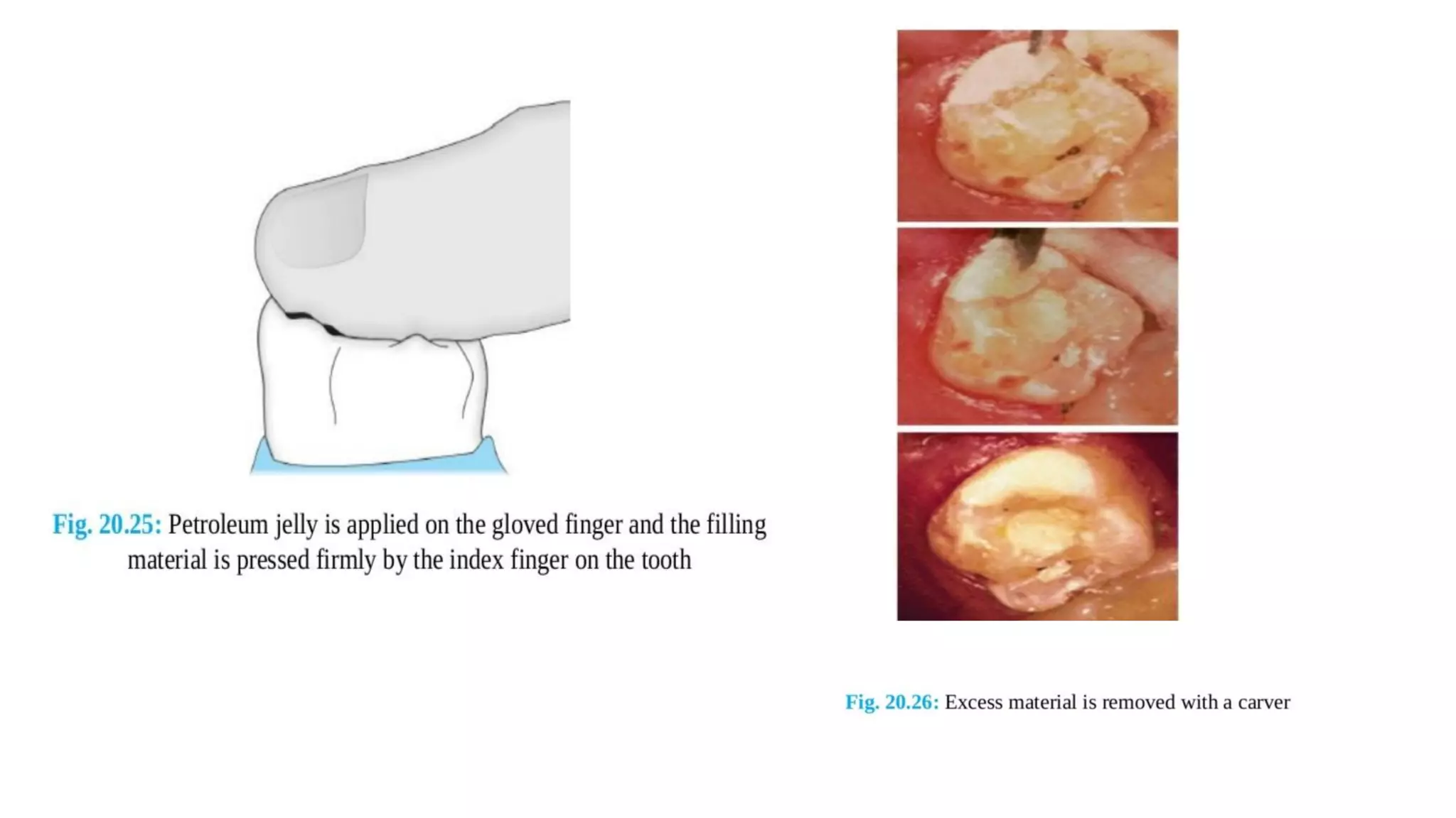 Atraumatic restorative treatment.pdf