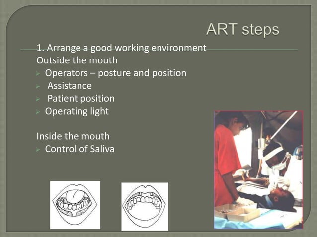 Atraumatic restorative treatment (art) for tooth | PPTX
