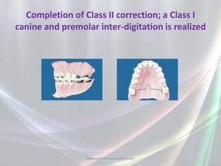 A treatment method for / dental courses /certified fixed orthodontic ...
