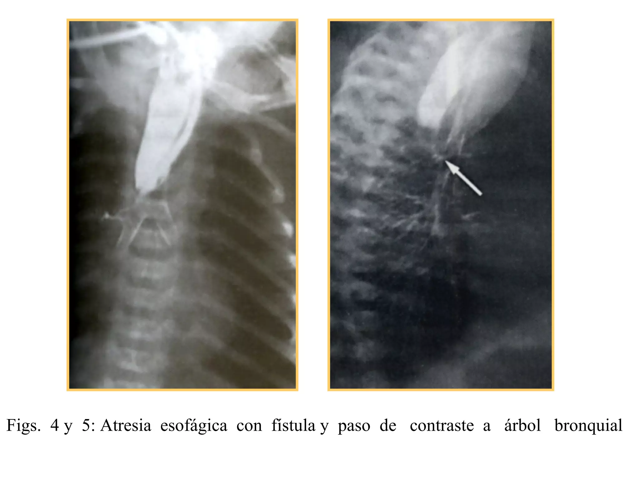 Atresia Esofagica | PPT