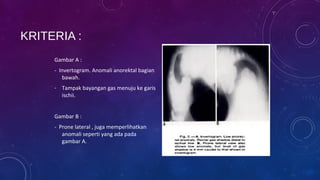 Atresia ani | PPT