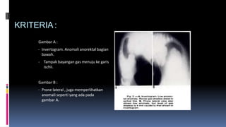 Atresia ani radiografi | PPT