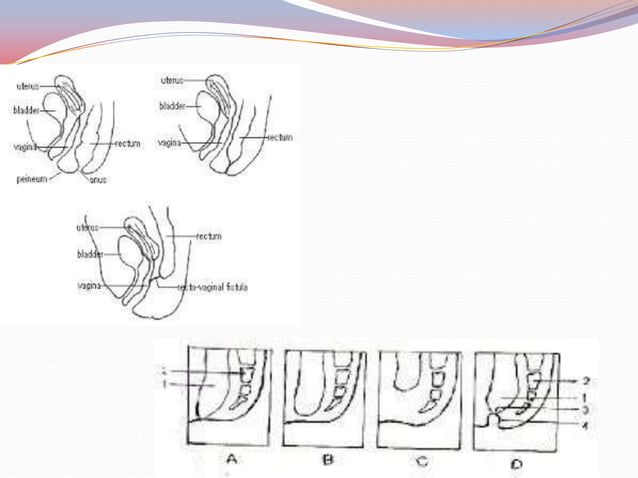 Atresia ani kelompok 3 non reg a bu henik | PPTX