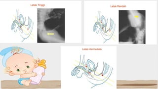 atresia ani pada anakgdjdnrjfnfjgngngn.pptx