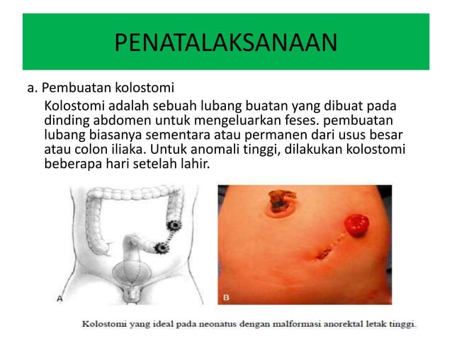 atresia ani merupakan suatu hal yan perlu di perhatikan | PPT