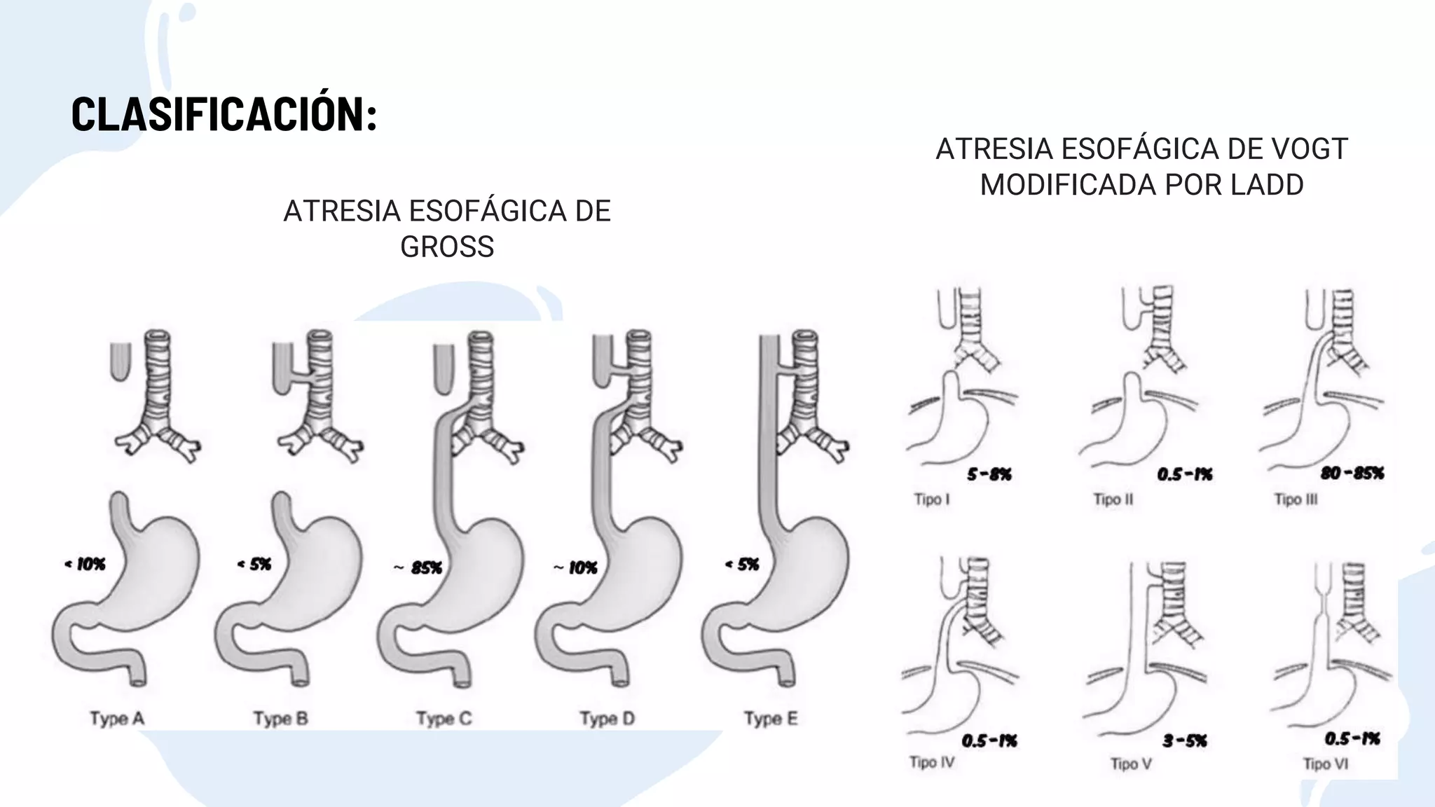 ATRESIA DE ESÓFAGO Y FISTULA TRAQUEOESOFÁGICA.pptx