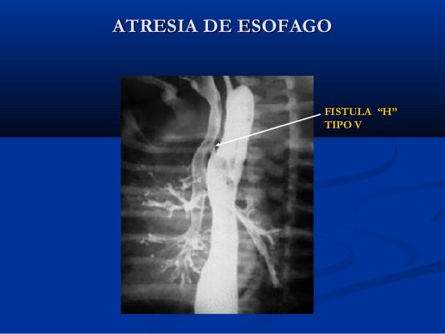 Atresia de esofago