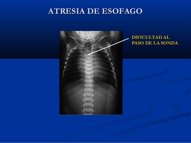 Atresia de esofago