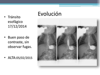 Atresia de esofago | PPTX