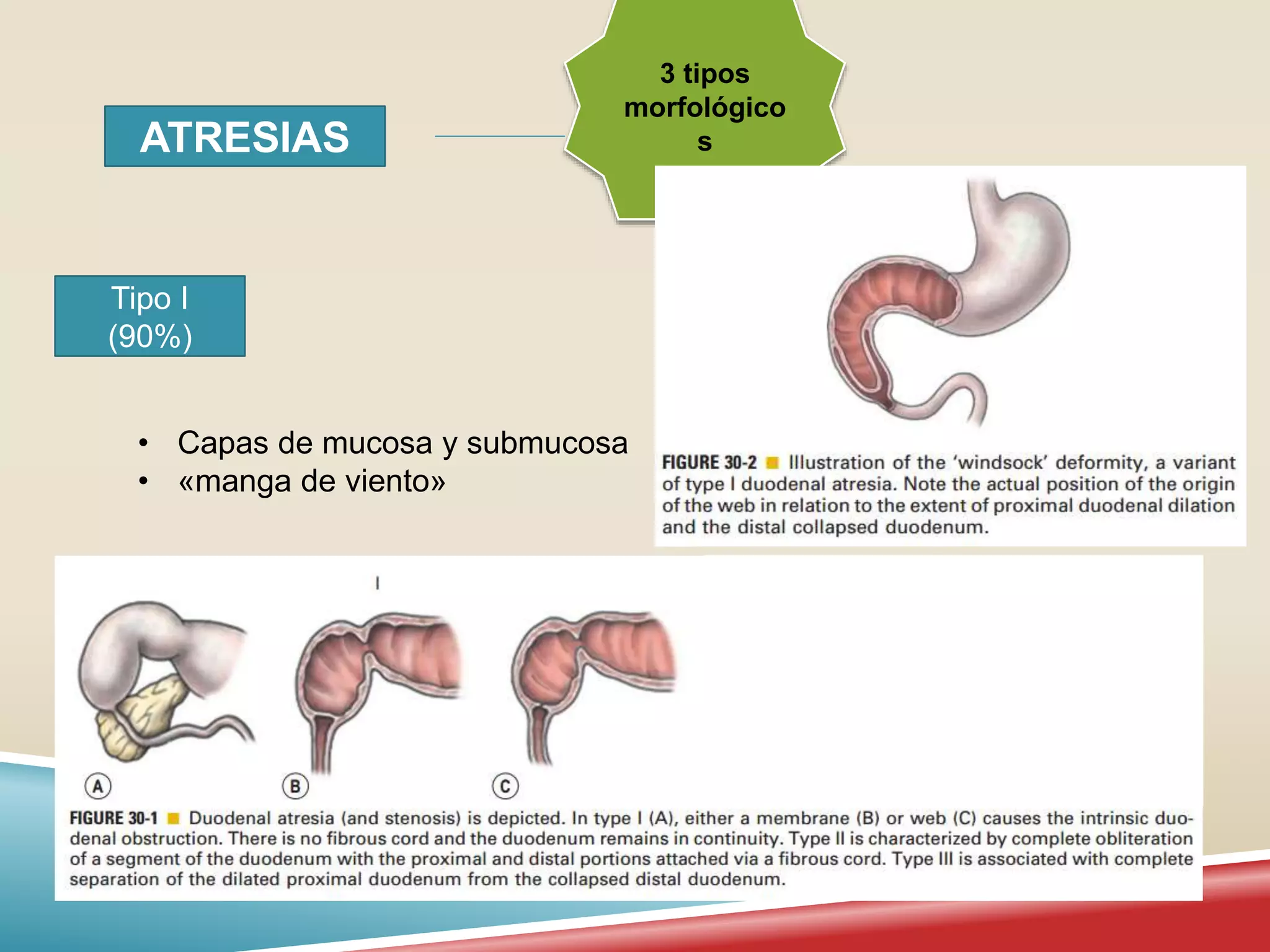 Atresia duodenal | PPT