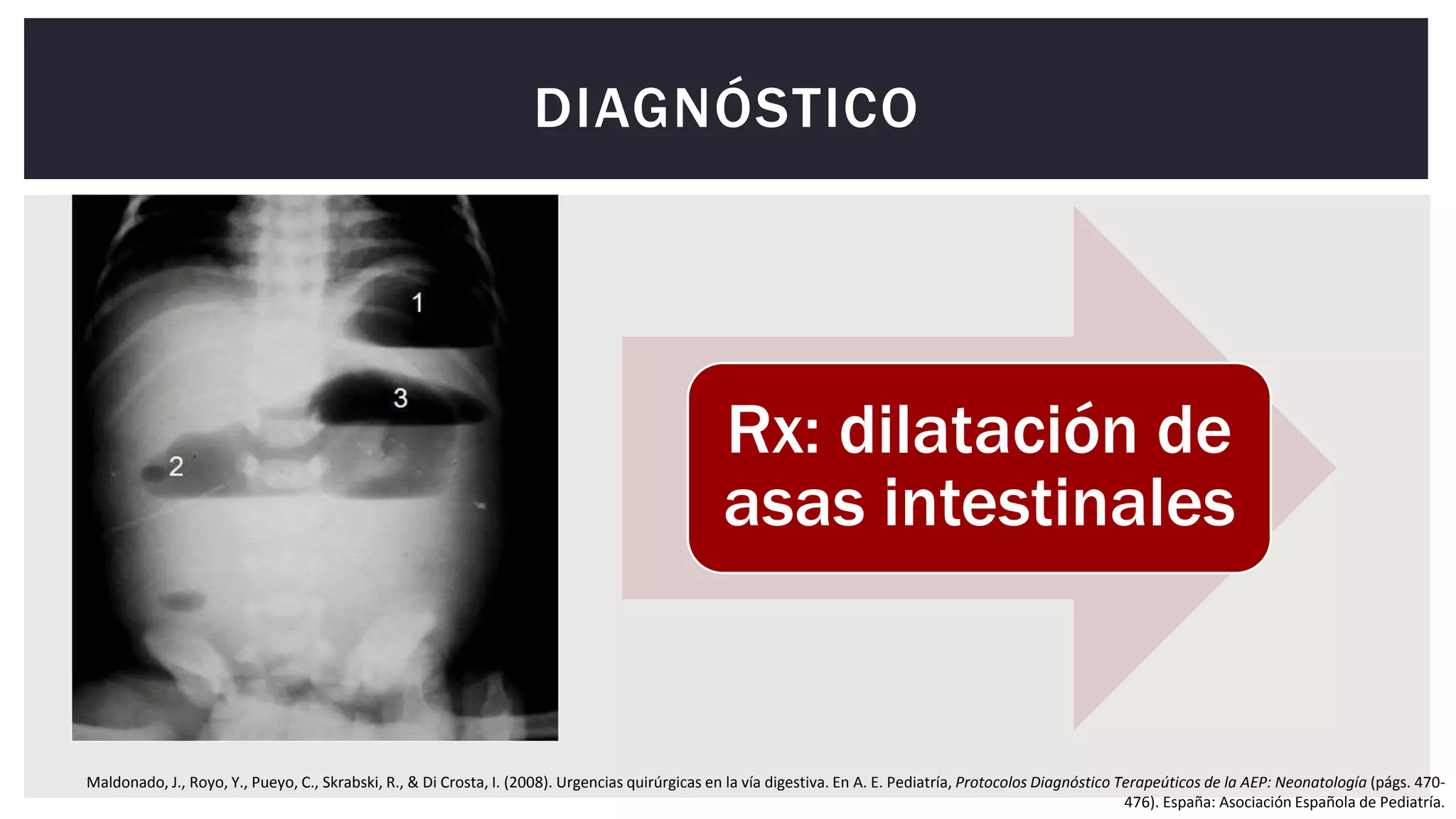 Atresia duodenal | PPTX