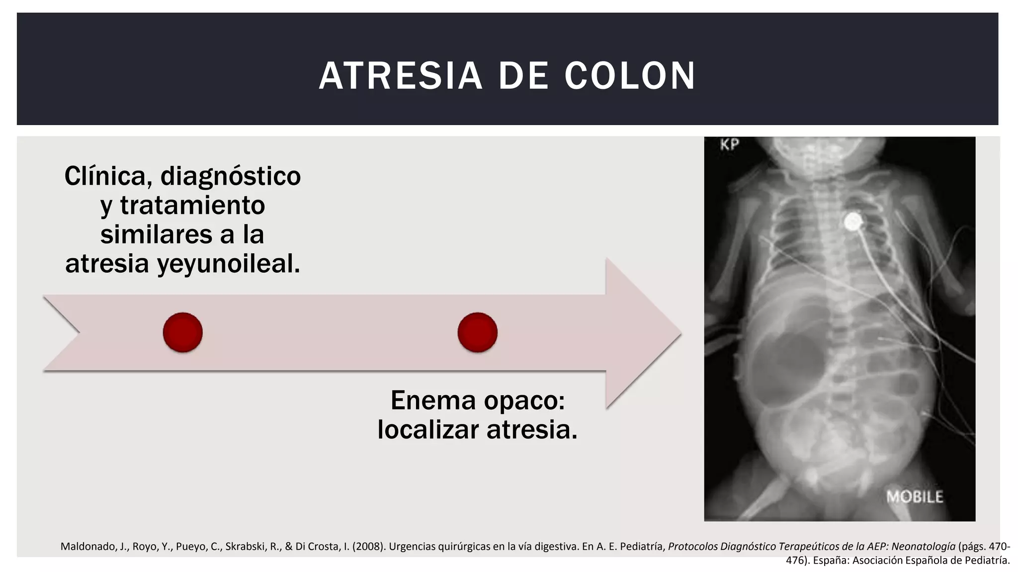 Atresia duodenal | PPTX