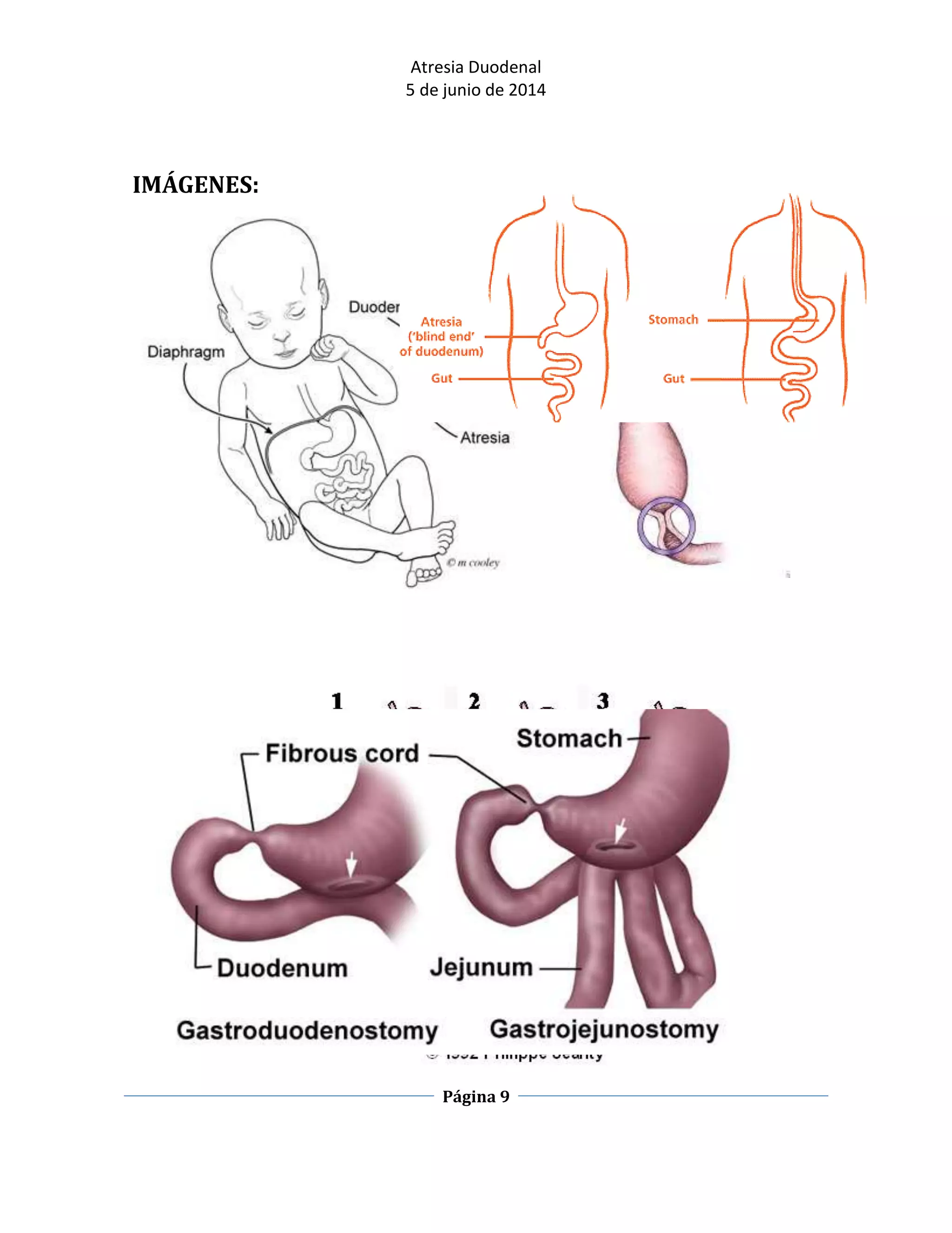 Atresia Duodenal | DOCX