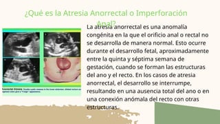 Atresia e Imperforacion anal (1).pptxidieiiekejej | PPTX