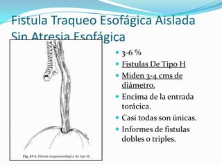 Atresia esofagica | PPTX