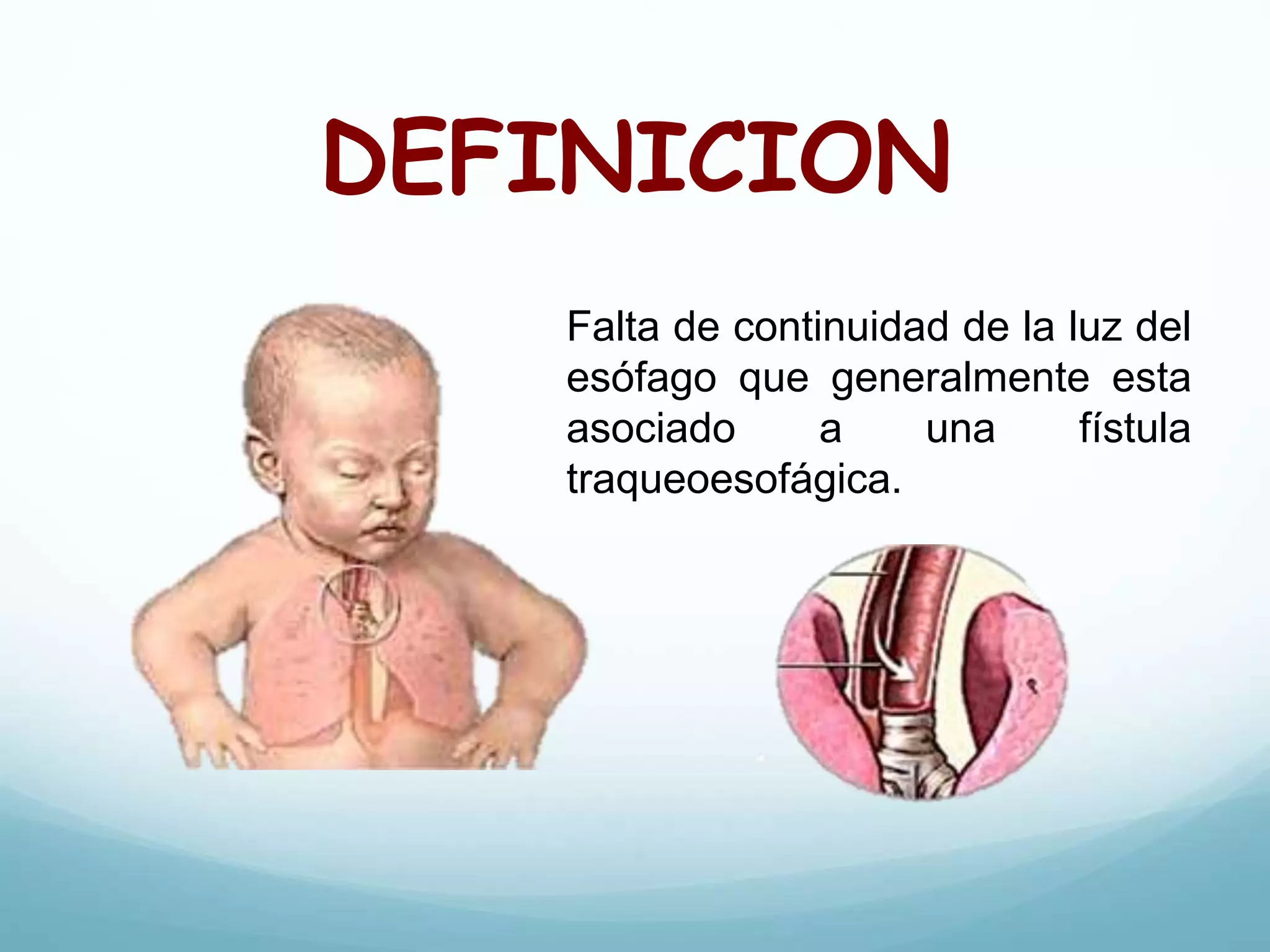 Atresia esofagica | PPTX