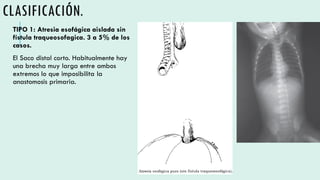 Atresia esofagica | PDF