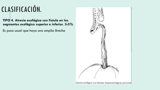 Atresia esofagica | PDF
