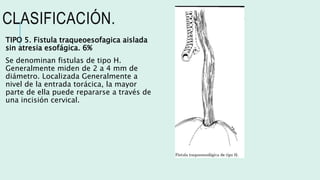 Atresia esofagica | PPTX