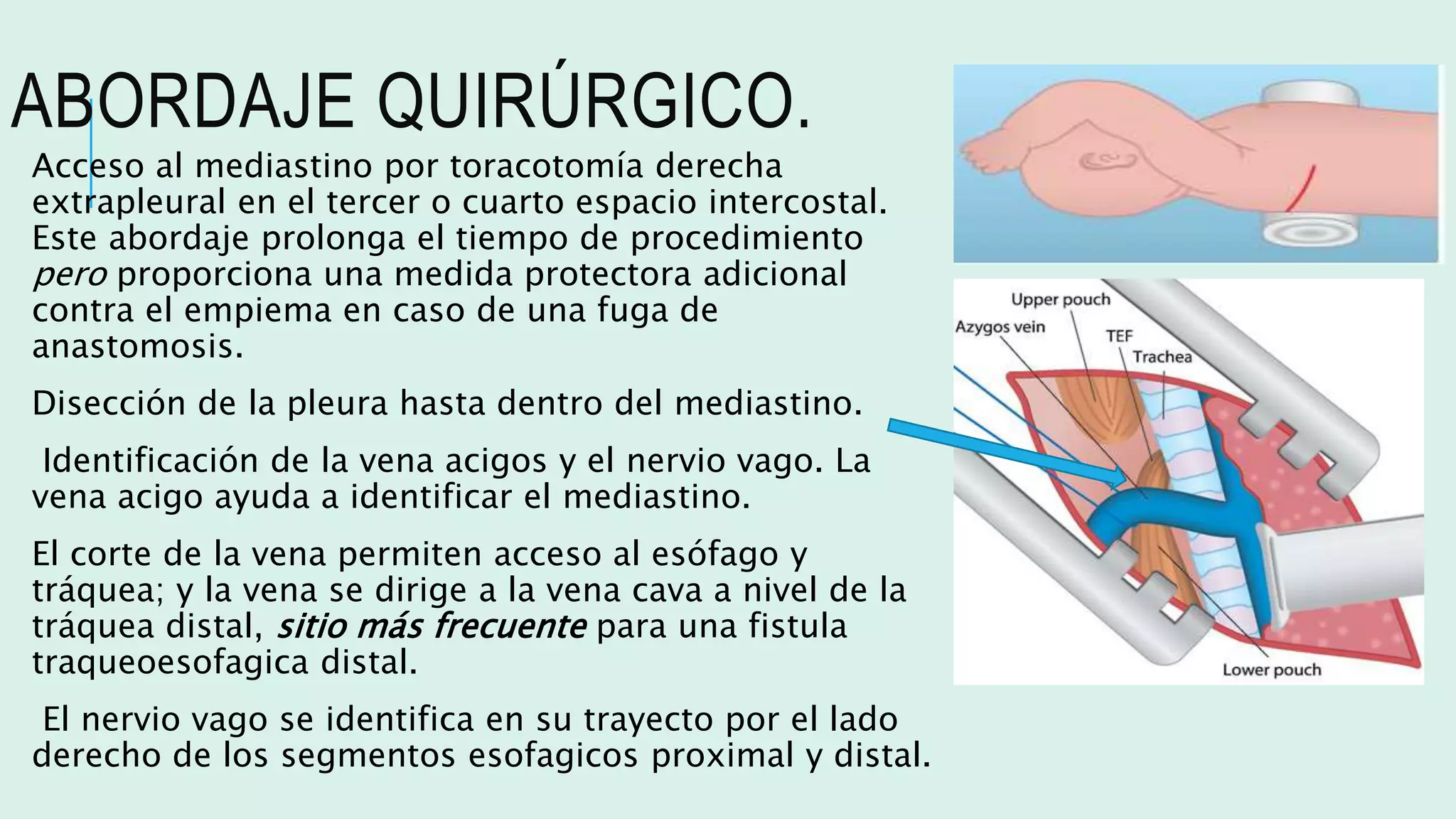 Atresia esofagica | PPT