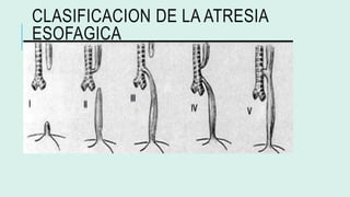 Atresia esofagica | PPTX