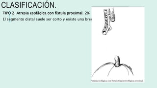 Atresia esofagica | PPTX