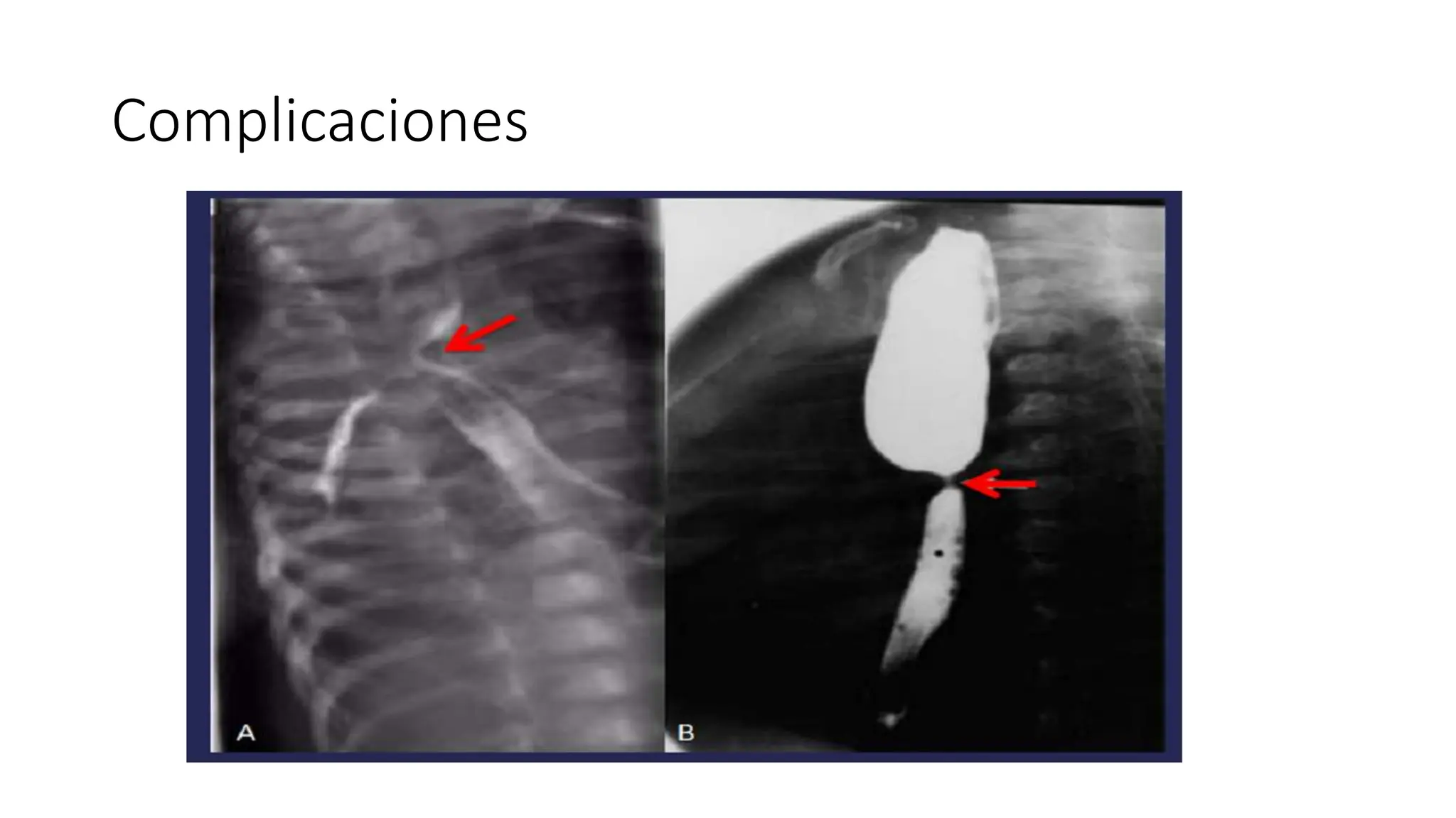 atresia esofagica en recien nacidos .pptx
