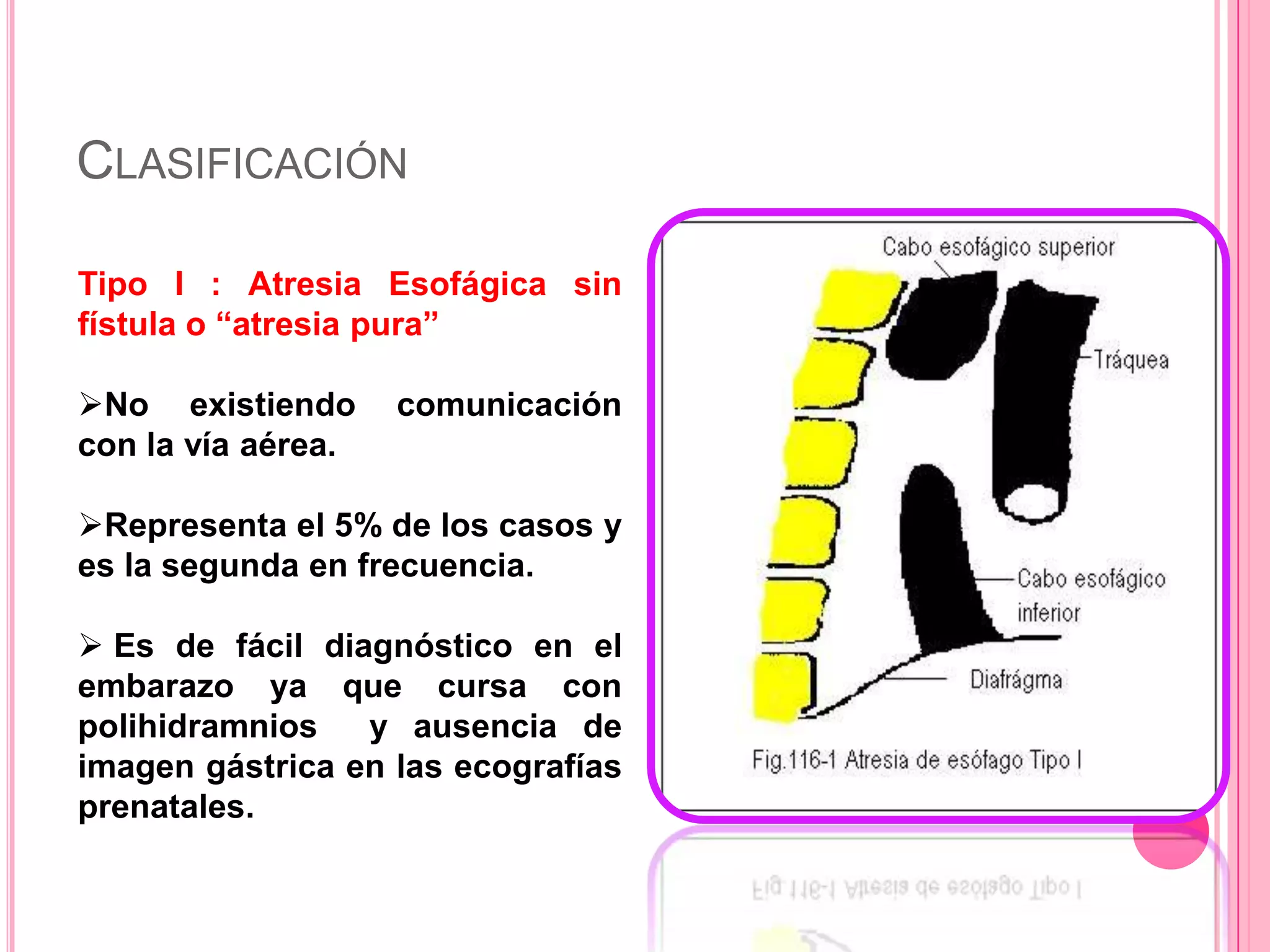 Atresia esofagica fistula traqueoesofagica | PPTX