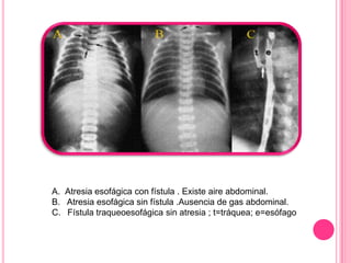 Atresia esofagica fistula traqueoesofagica | PPTX