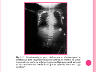 Atresia esofagica fistula traqueoesofagica | PPTX