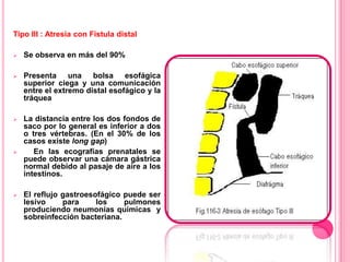 Atresia esofagica fistula traqueoesofagica | PPTX
