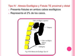 Atresia esofagica fistula traqueoesofagica | PPTX