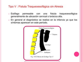 Atresia esofagica fistula traqueoesofagica | PPTX