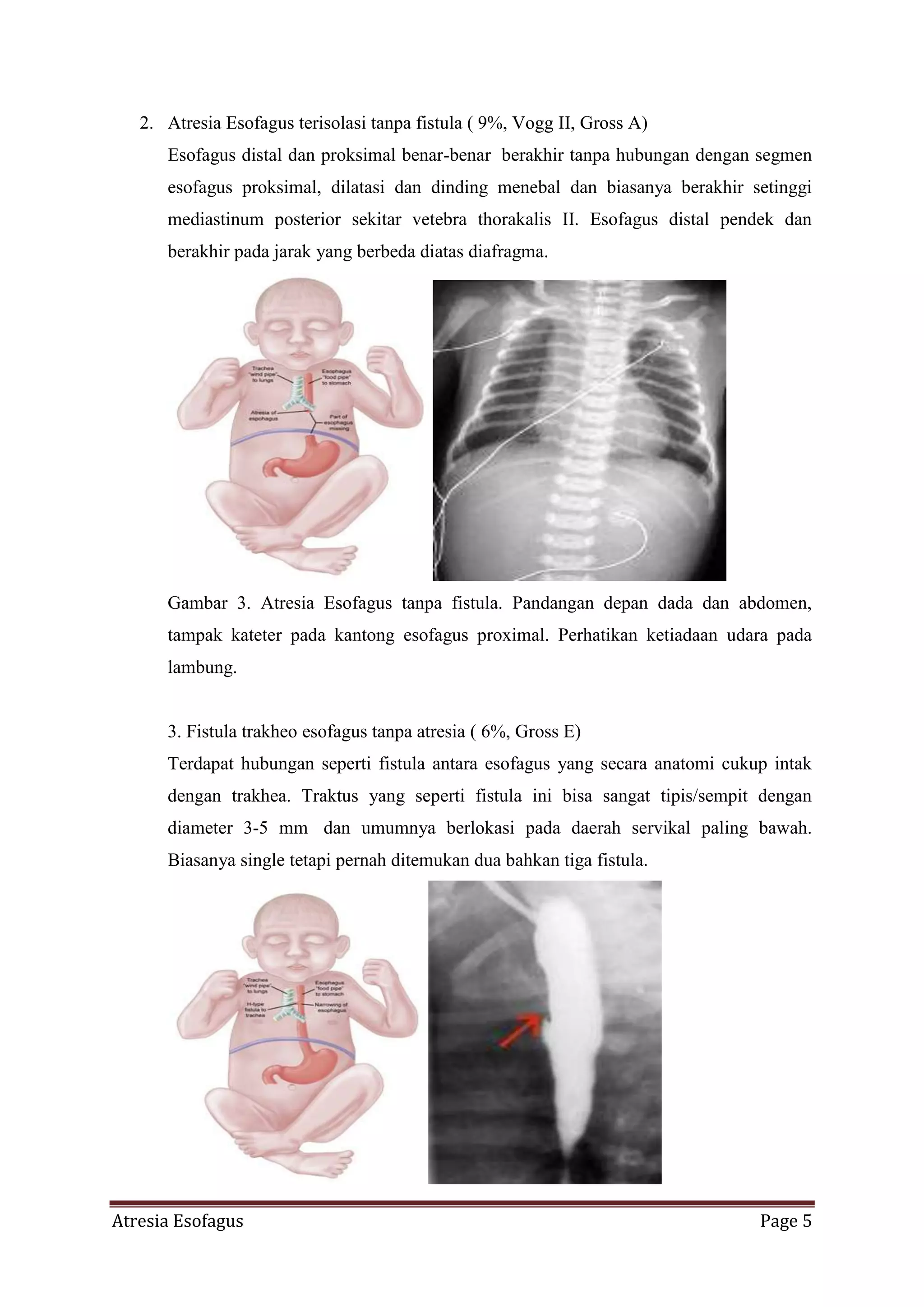 Atresia esofagus | DOCX