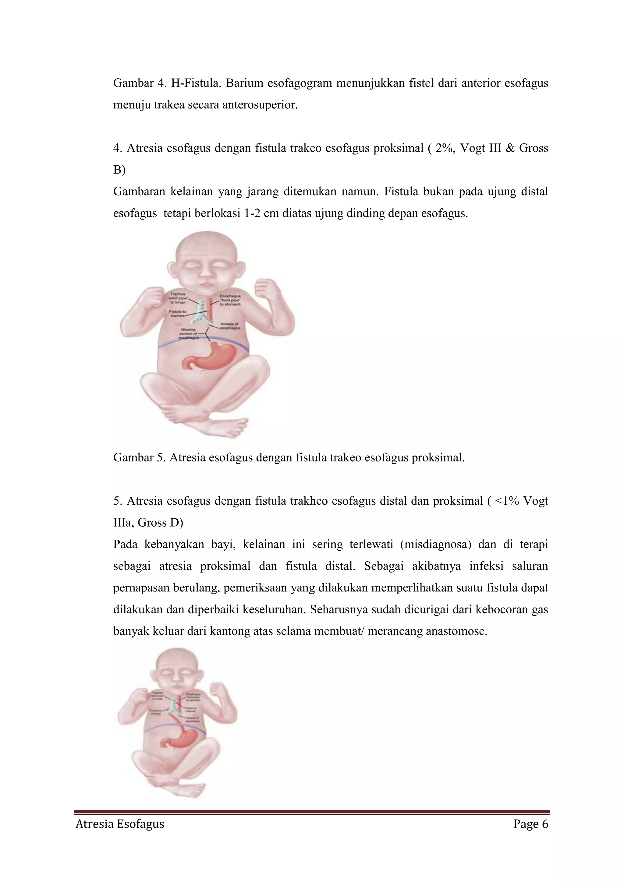 Atresia esofagus | DOCX