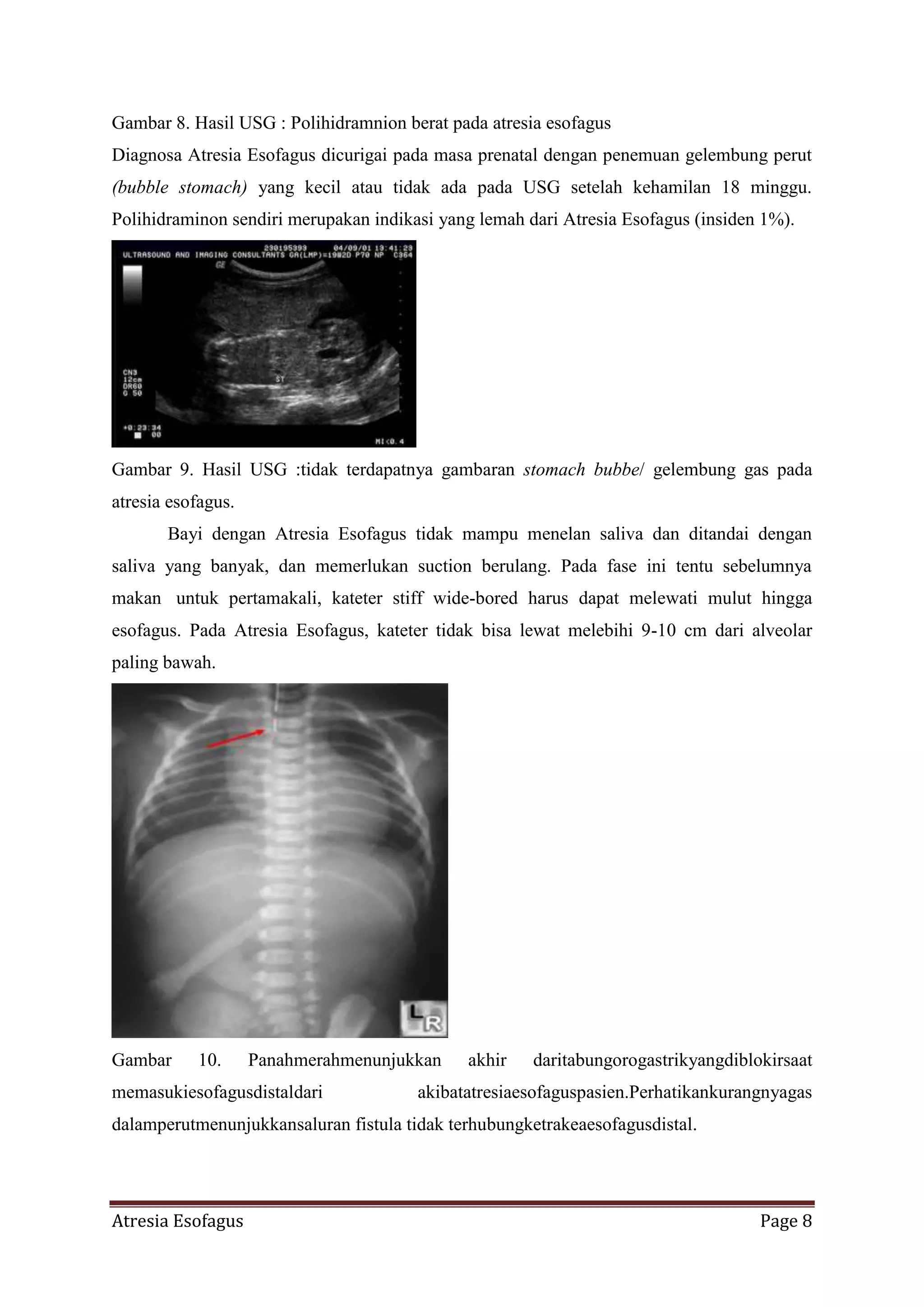 Atresia esofagus | DOCX
