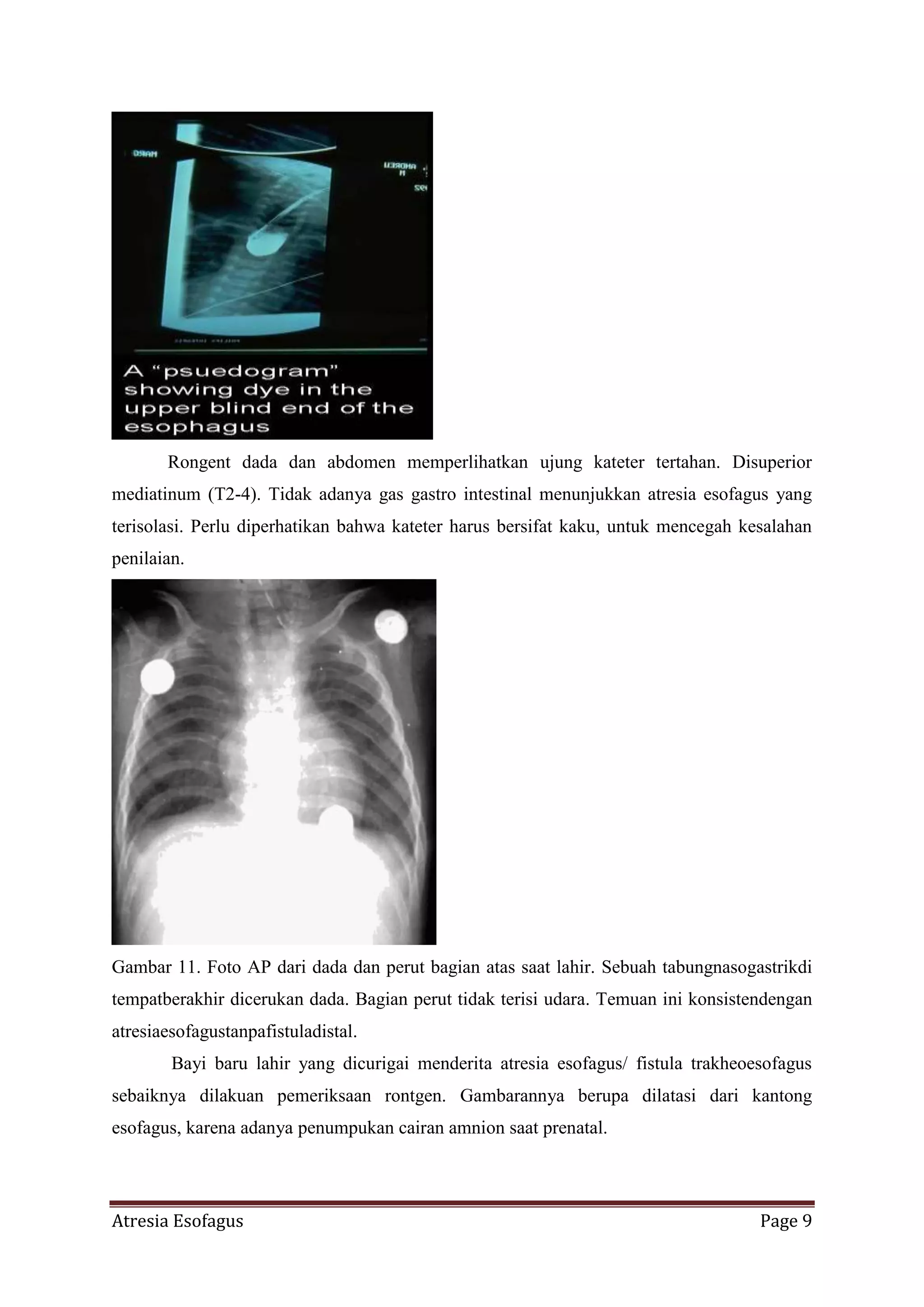 Atresia esofagus | DOCX