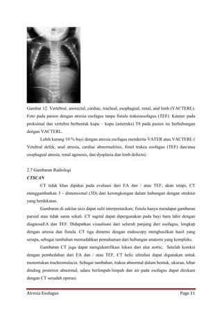 Atresia esofagus | DOCX