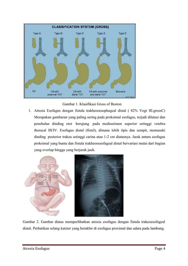 Atresia esofagus | DOCX