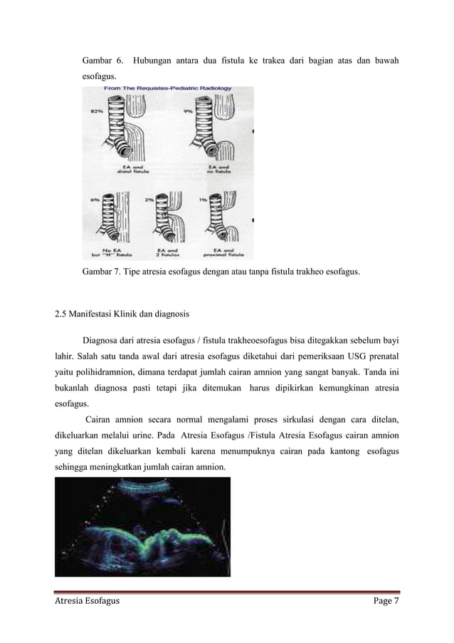 Atresia esofagus | DOCX