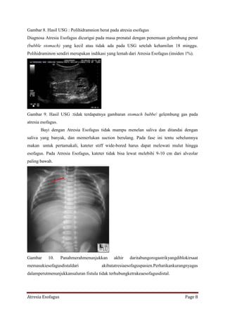 Atresia esofagus | DOCX