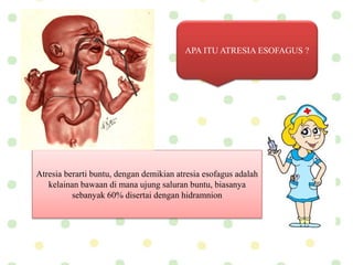 Atresia esofagus | PPTX