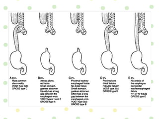 Atresia esofagus | PPTX